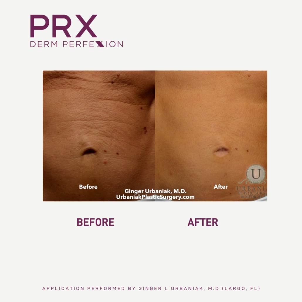 prx before and after body 4 days - The MedSpa Raleigh